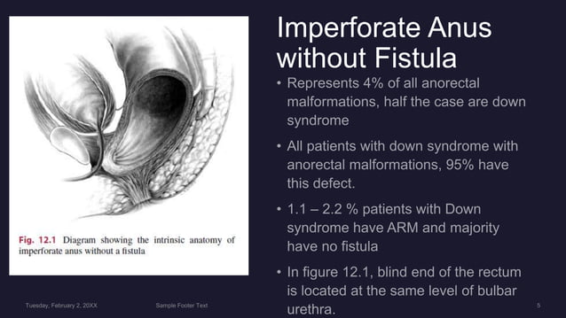 CASE Presentation Anorectal Malformation.pptx | Pregnancy ...