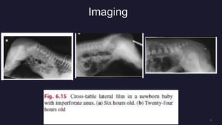 CASE Presentation Anorectal Malformation.pptx