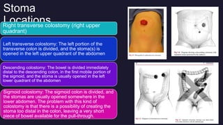 CASE Presentation Anorectal Malformation.pptx
