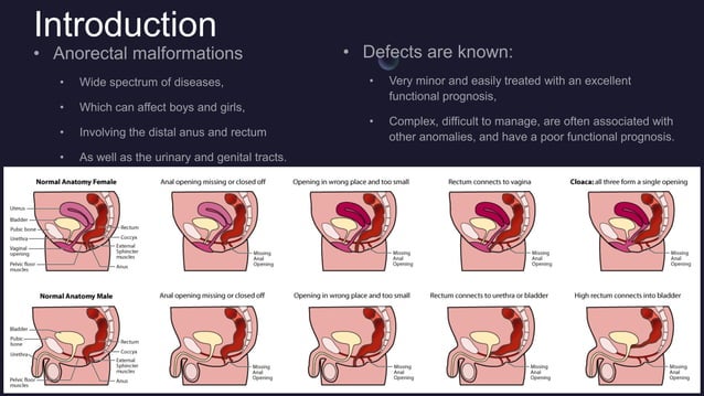CASE Presentation Anorectal Malformation.pptx