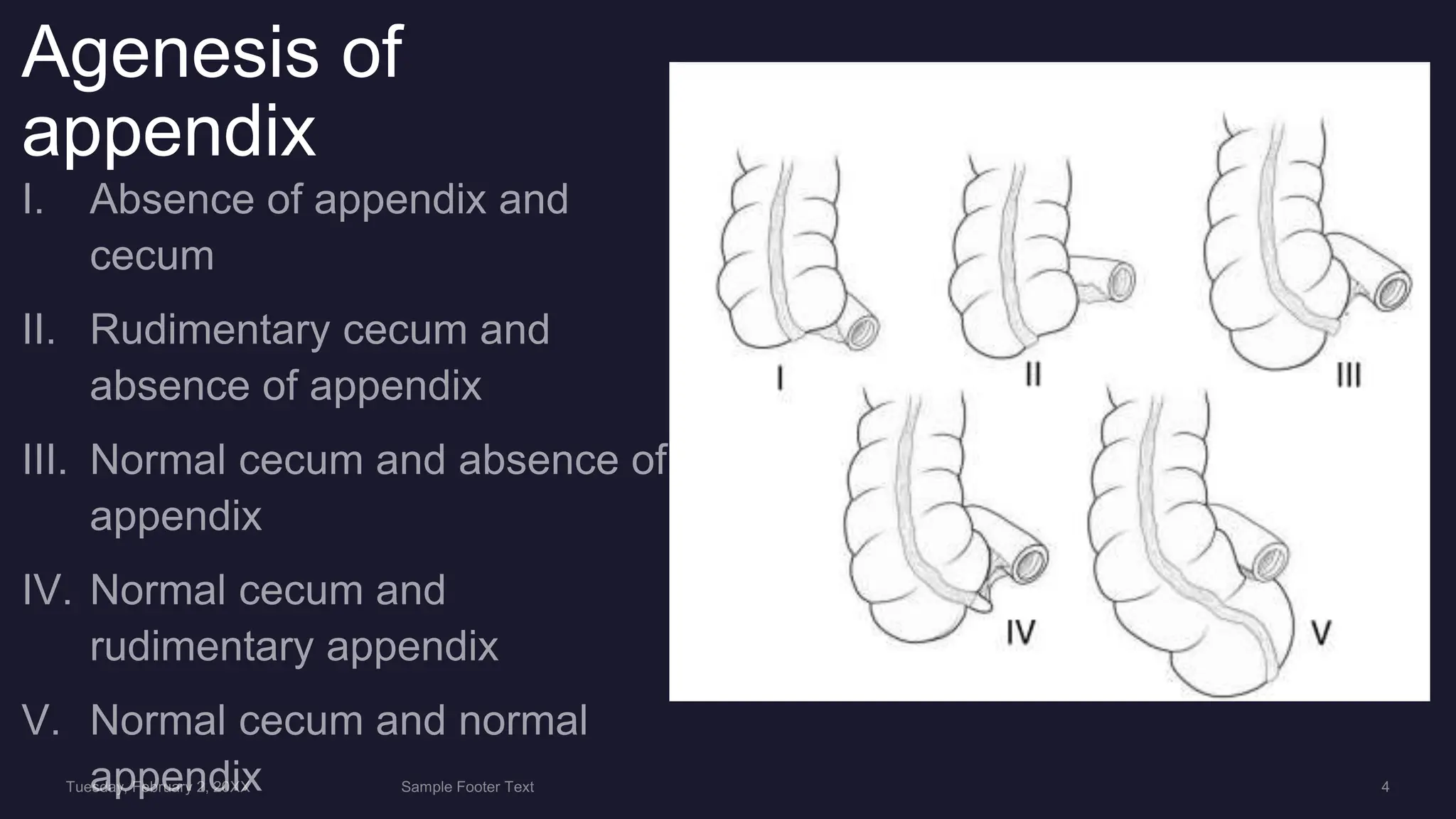 CASE Report General Surgery Residency Presentation Appendicitis.pptx | Digestive Disorders ...