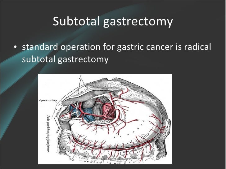 Radical Subtotal Gastrectomy Surgery For Gastric Ca | PPTX