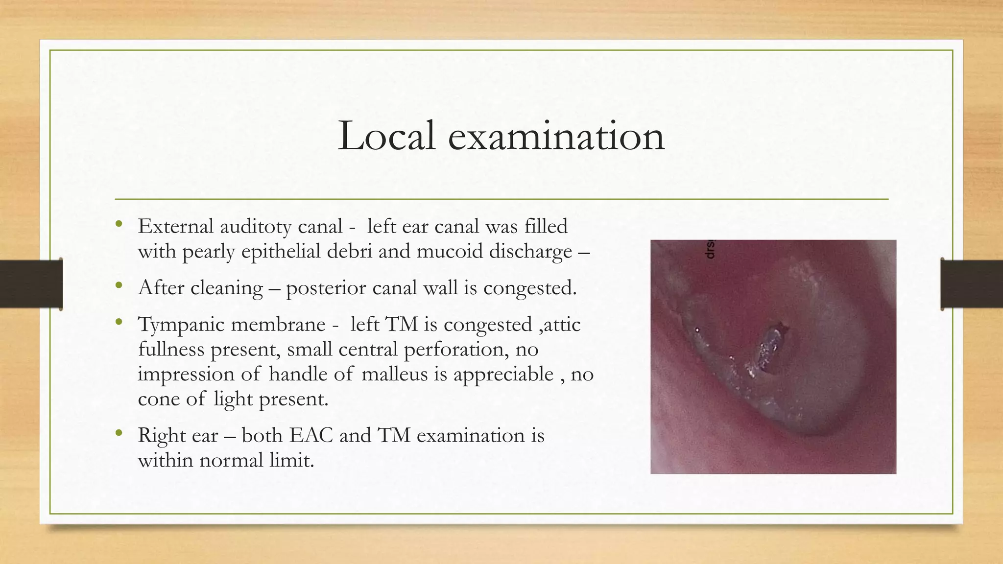 Cholesteatoma Case Presentation .pptx