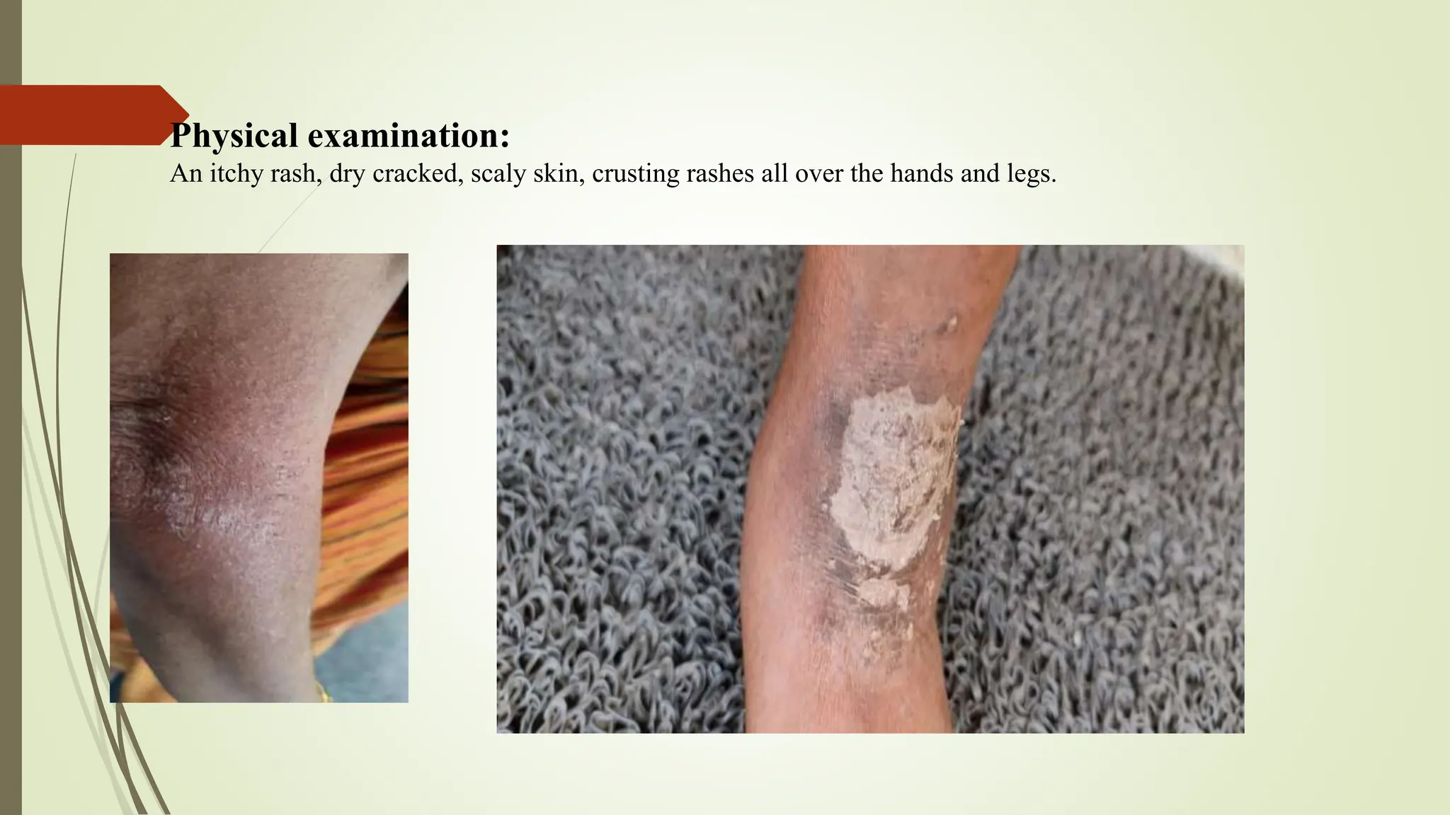 CASE PRESENTATION derma2 pptx.pptx