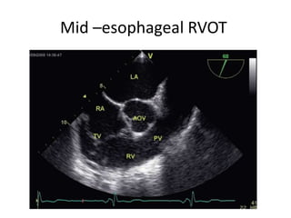 Case presentation ,double chambered right ventricle | PPTX