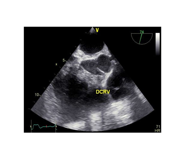 Case presentation ,double chambered right ventricle | PPTX