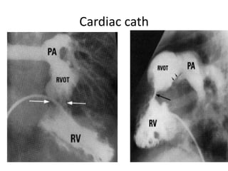 Case presentation ,double chambered right ventricle | PPTX