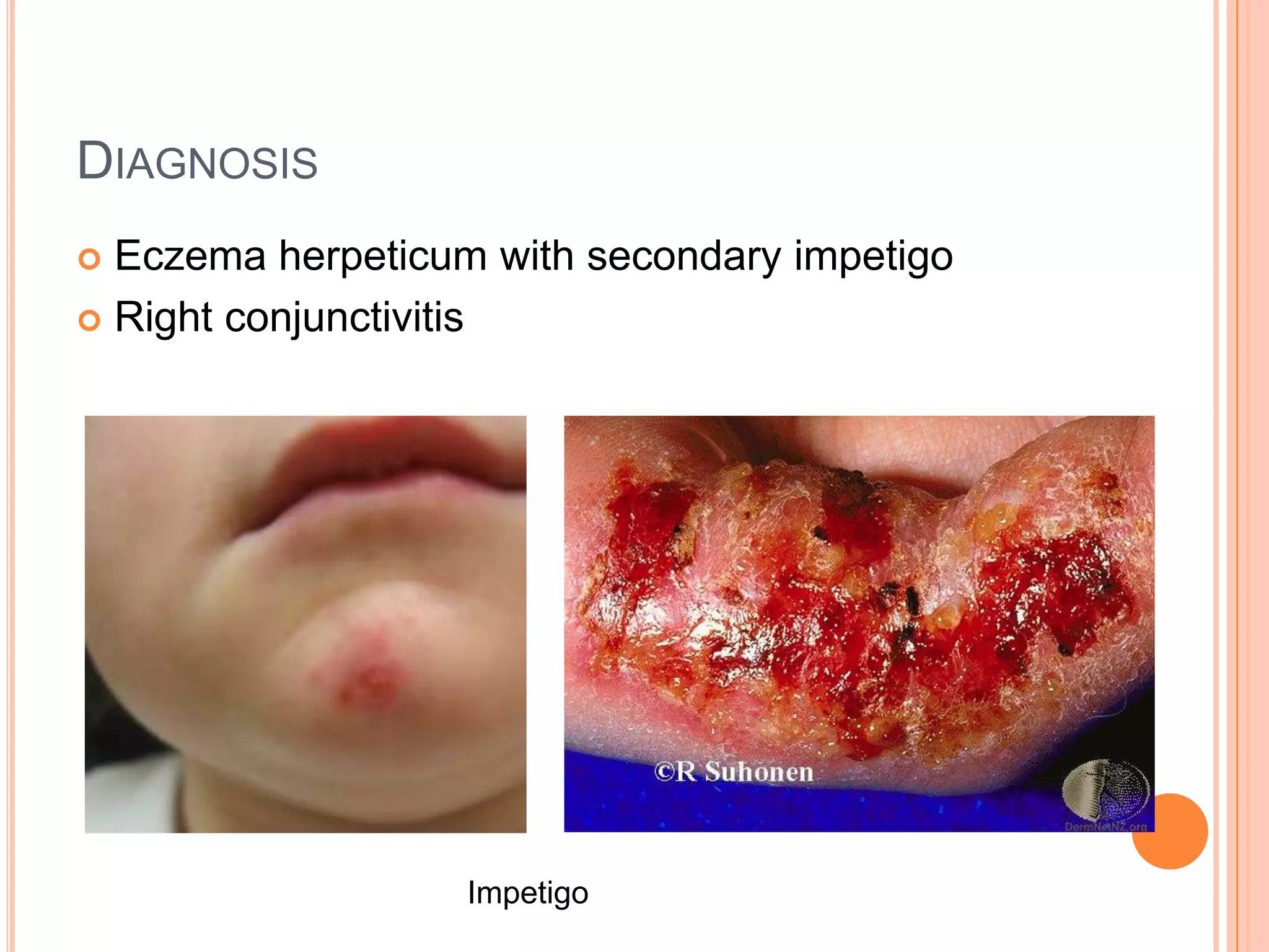 Case presentation eczema herpeticum | PPTX | Infectious Diseases ...