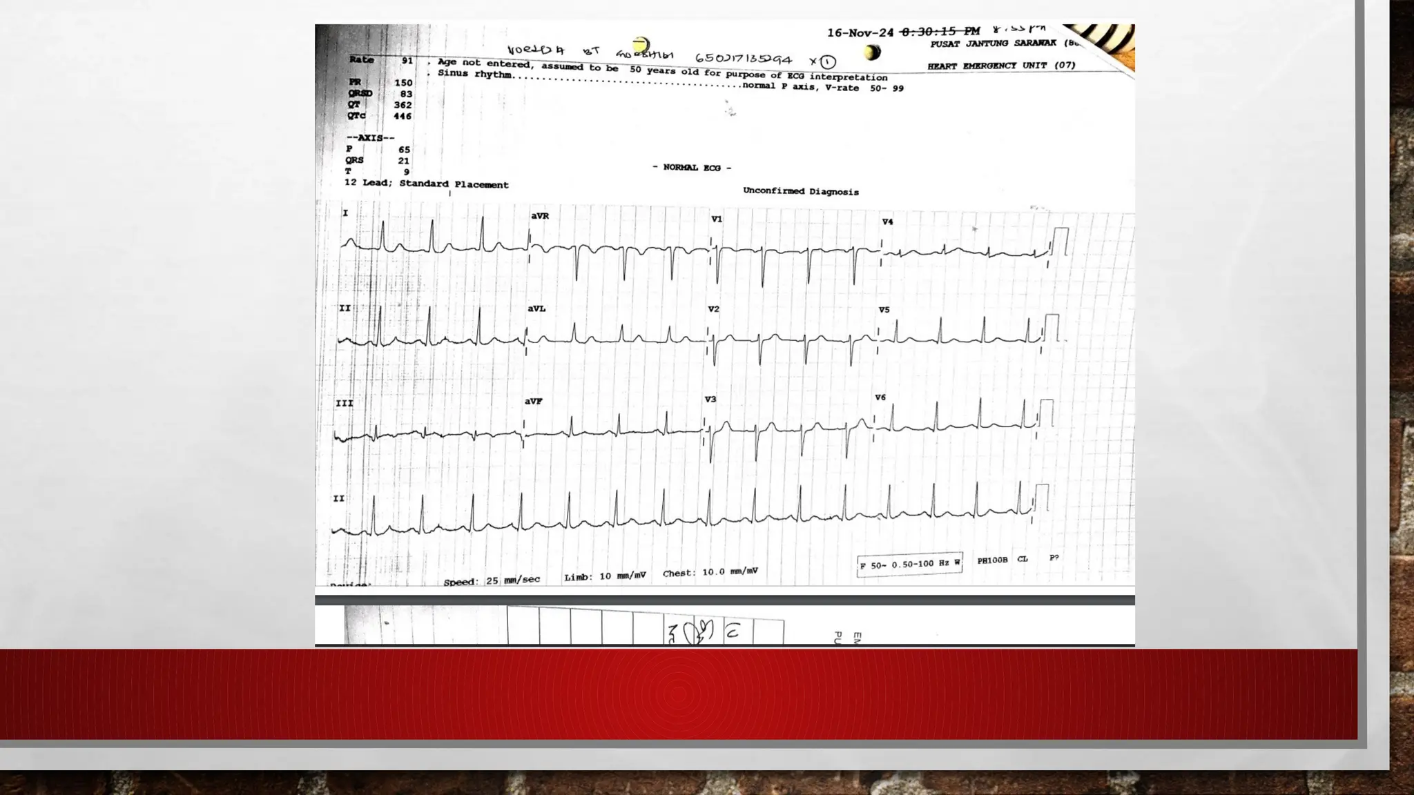 a CASE PRESENTATION FOR NSTEMI eric.pptx