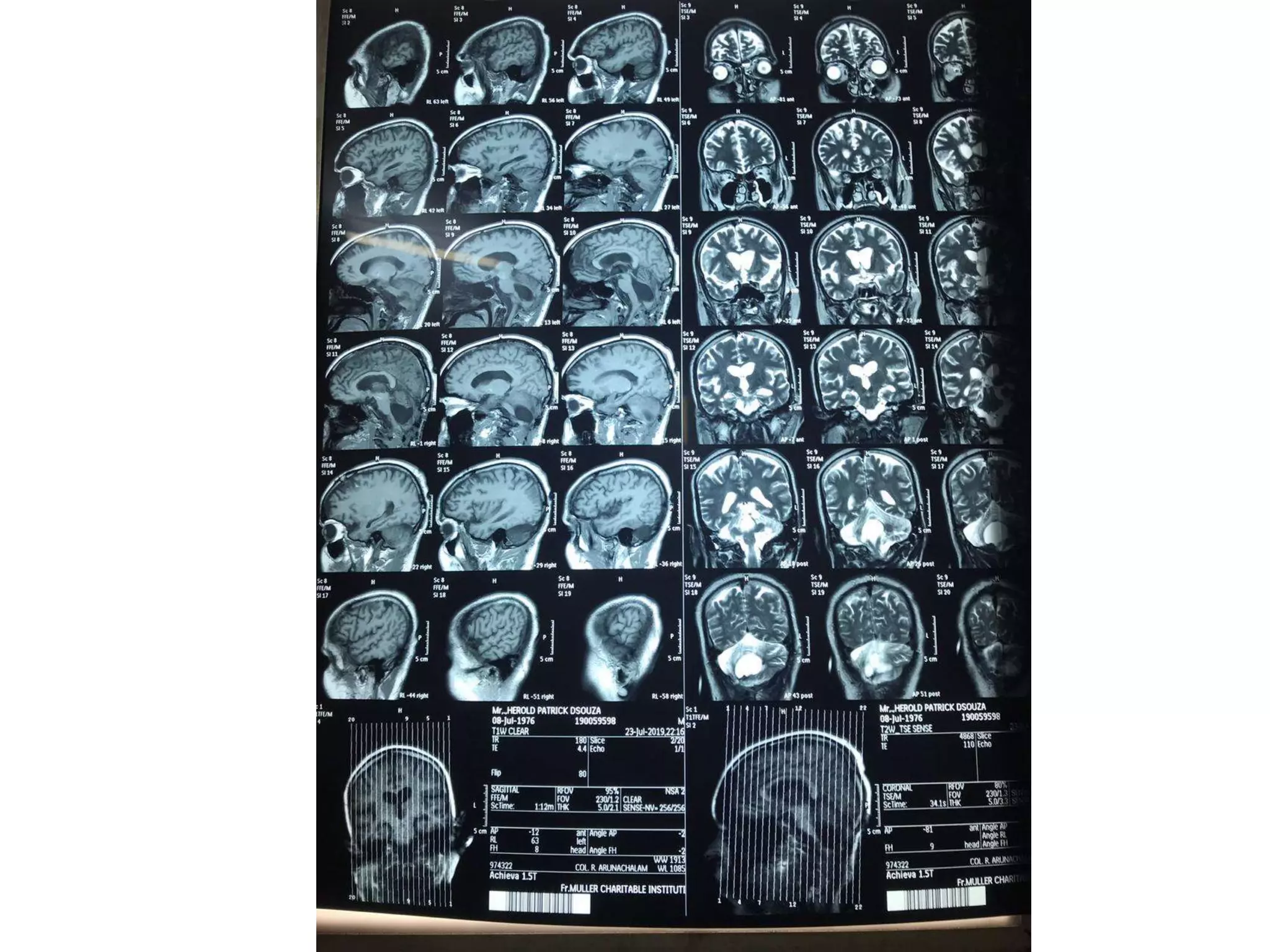 locked in syndrome | PPTX