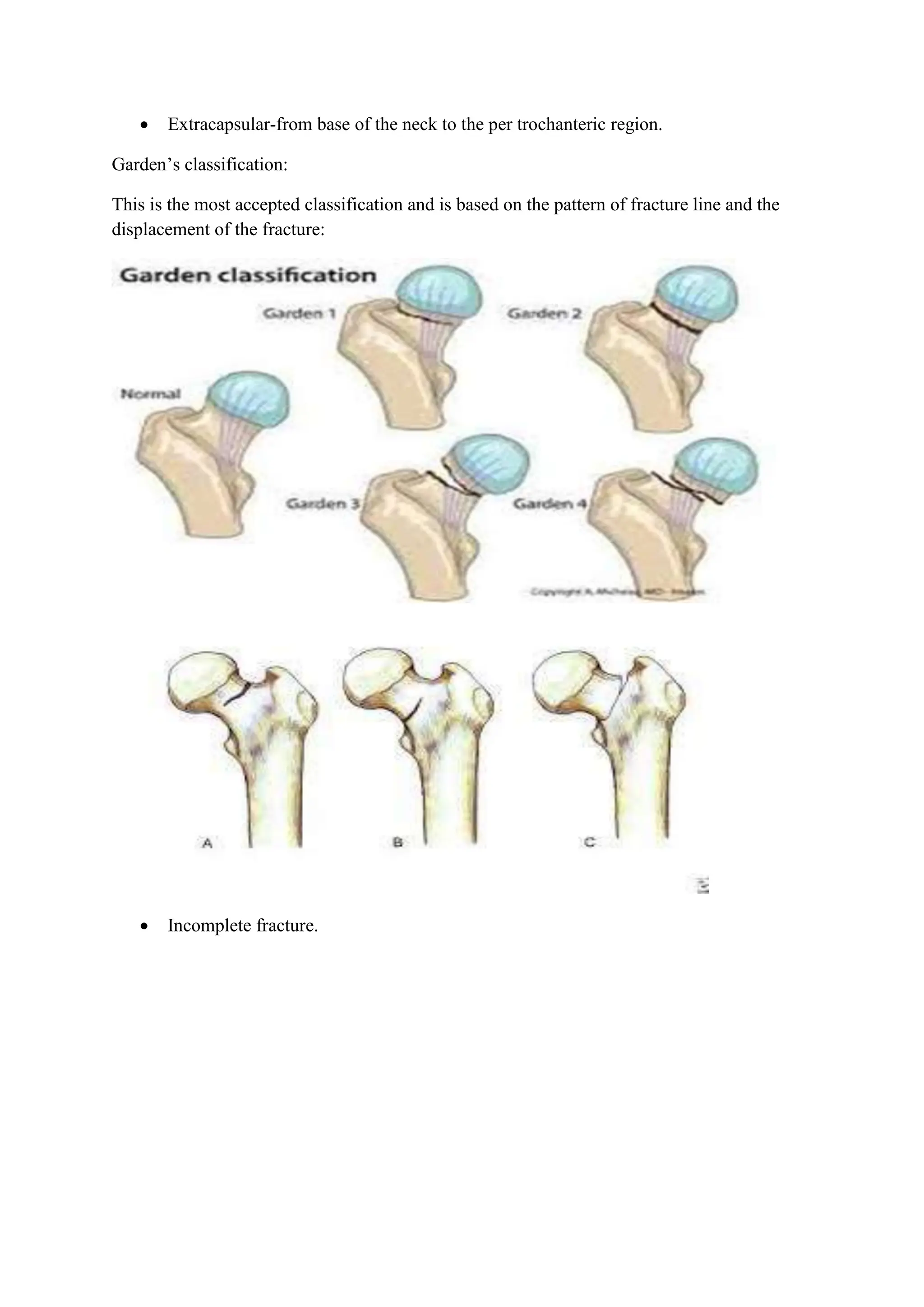 A complete case presentation on hip fracture. | DOCX