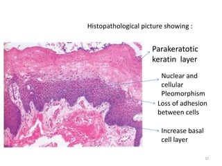 Case presentation hyperkeratotic lession | PPTX