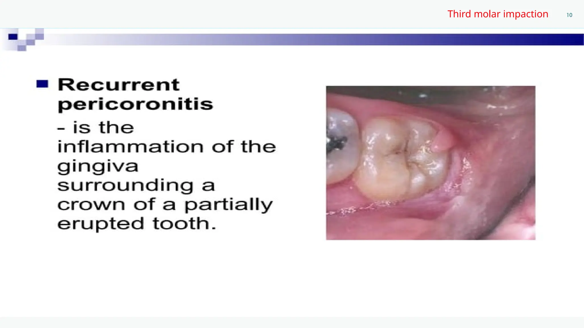 Case presentation about impacted third molar.pptx