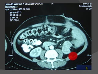 Case presentation (metastatic rcc) | PPT