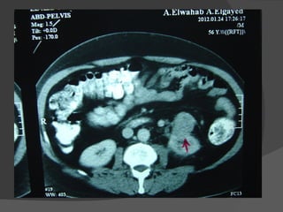 Case presentation (metastatic rcc) | PPT