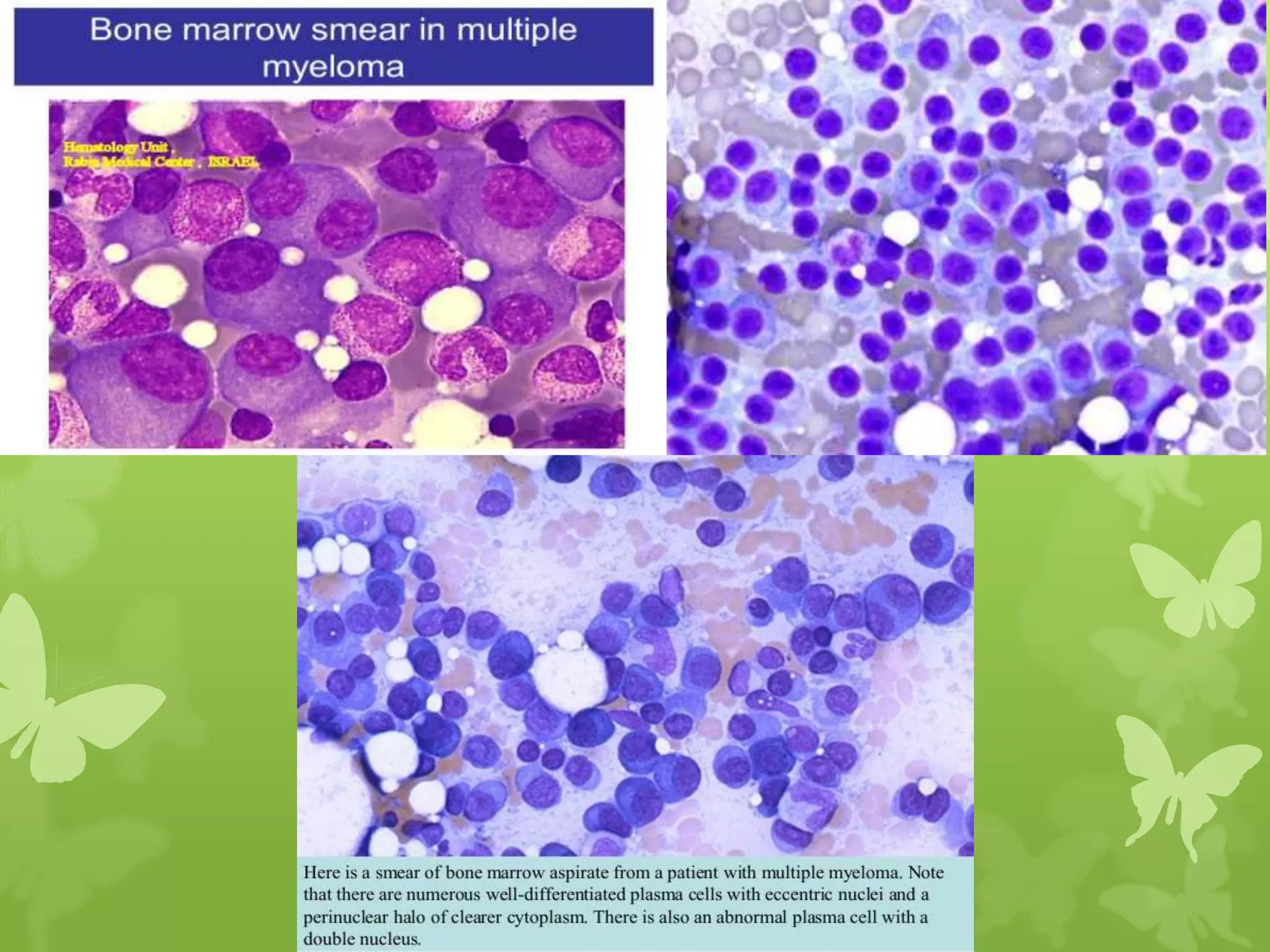 Multiple Myeloma (Case presentation) | PPTX