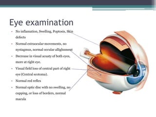 Optic neuritis and multiple sclerosis | PPTX