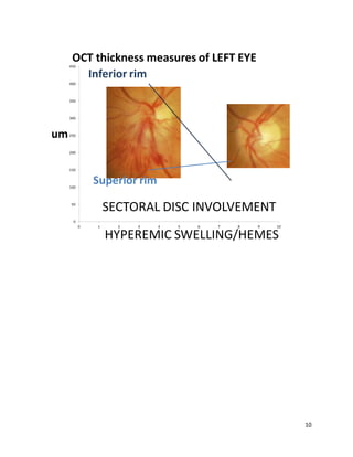 Case presentation of a swollen optic disc | DOCX