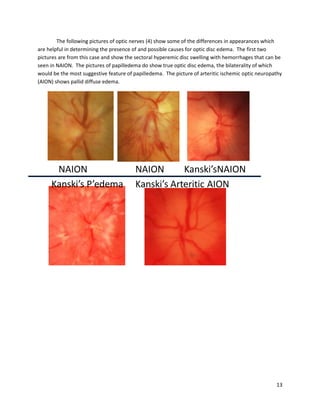 Case presentation of a swollen optic disc | DOCX