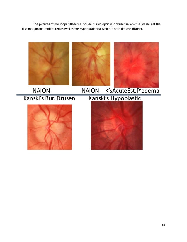 Case presentation of a swollen optic disc