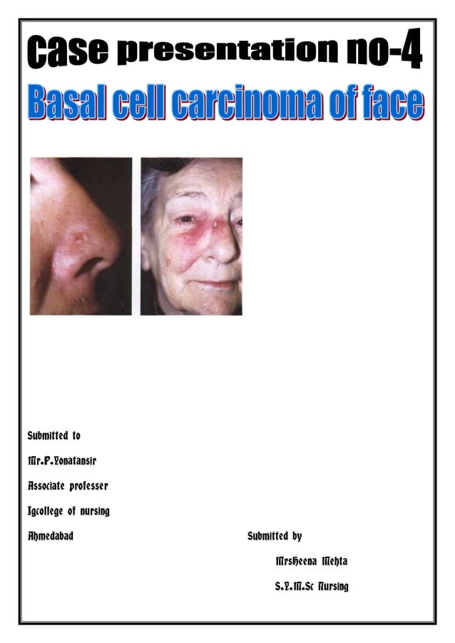 Case presentation of basal cell carcinoma of face no 4 | DOCX | Skin ...