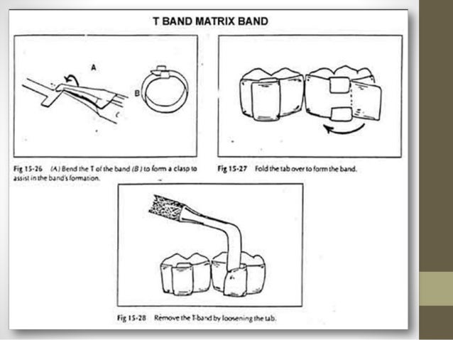 Case presentation of dislodged class 2 composite filling.pptx