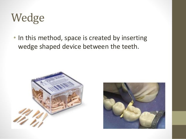 Case presentation of dislodged class 2 composite filling.pptx