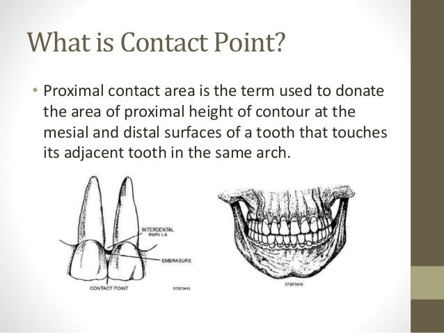 Case presentation of dislodged class 2 composite filling.pptx