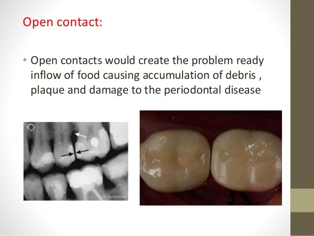 Case presentation of dislodged class 2 composite filling.pptx