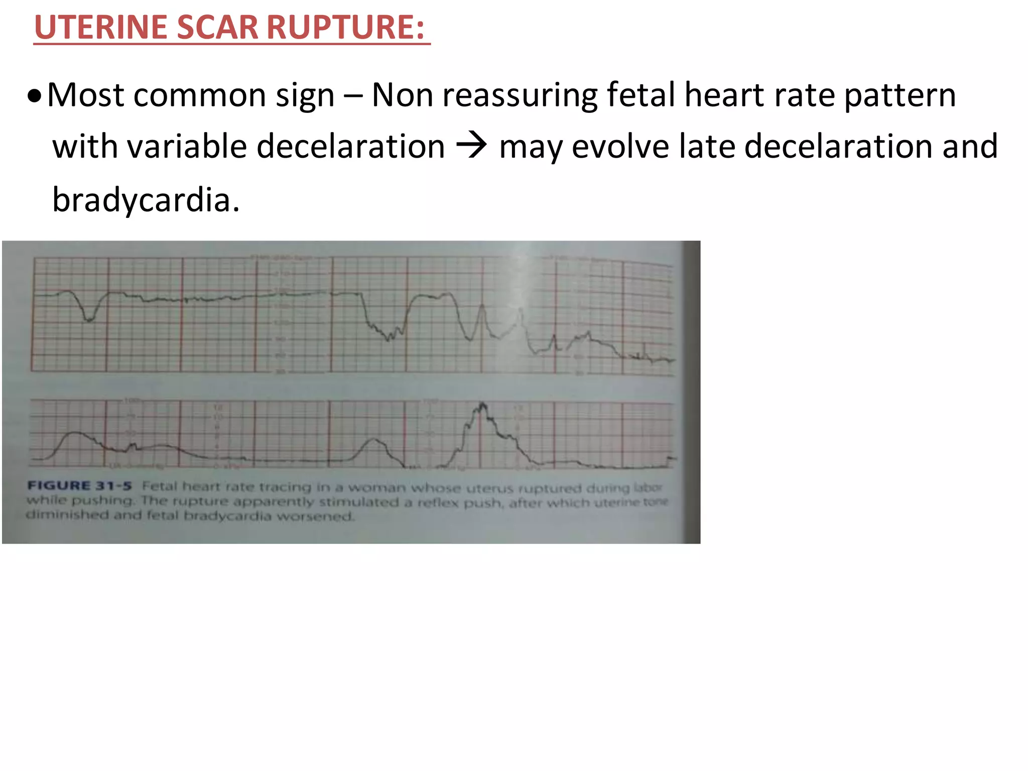 Case presentation of previous two cesarean section | DOCX