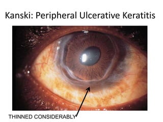 Peripheral Ulcerative Keratitis