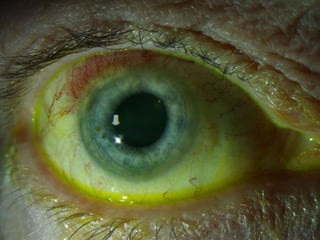 Infiltrative Keratitis