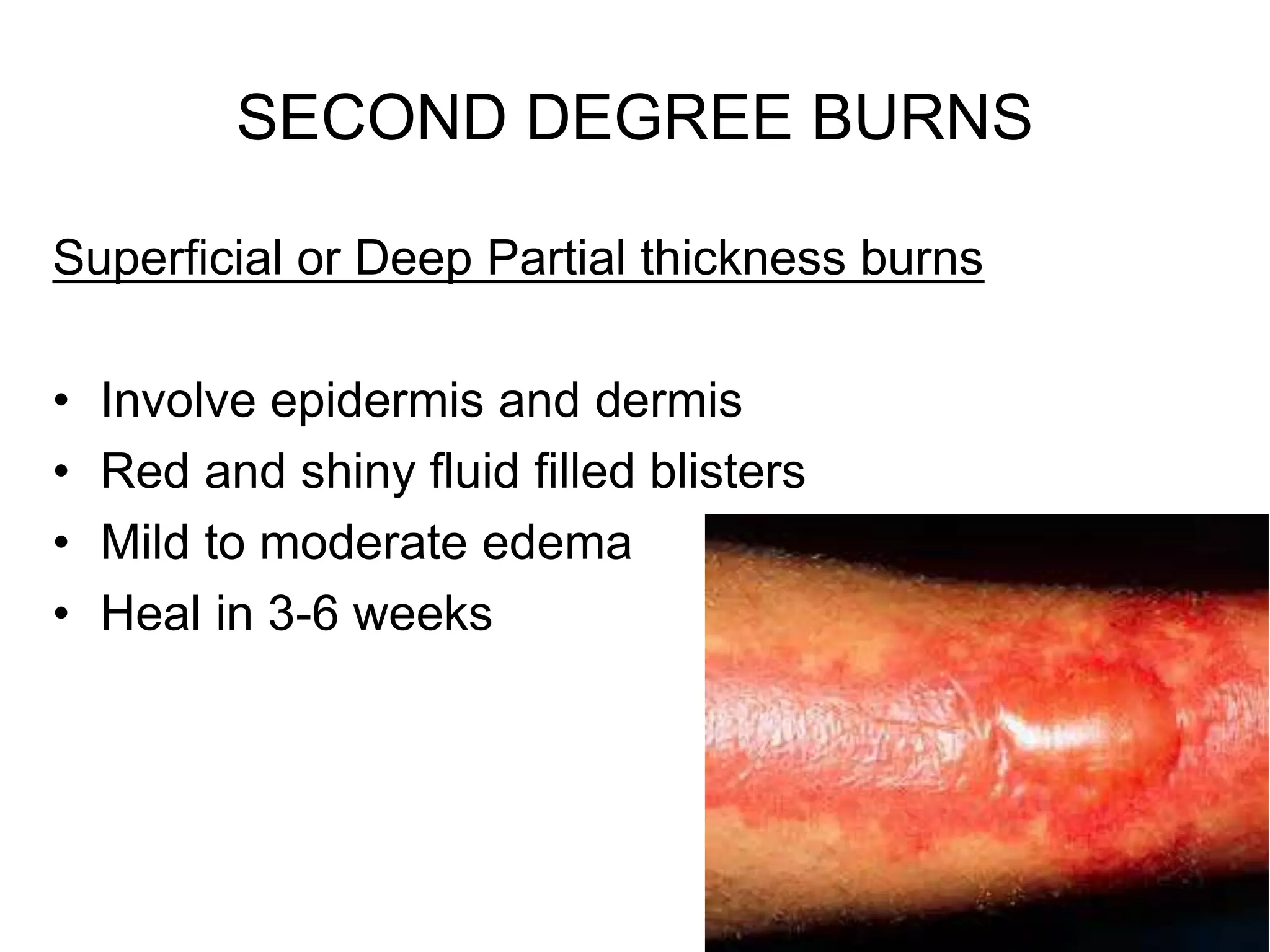 CASE PRESENTATION ON 2ND AND 3RD DEGREE BURNS.pptx