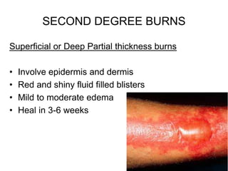 CASE PRESENTATION ON 2ND AND 3RD DEGREE BURNS.pptx