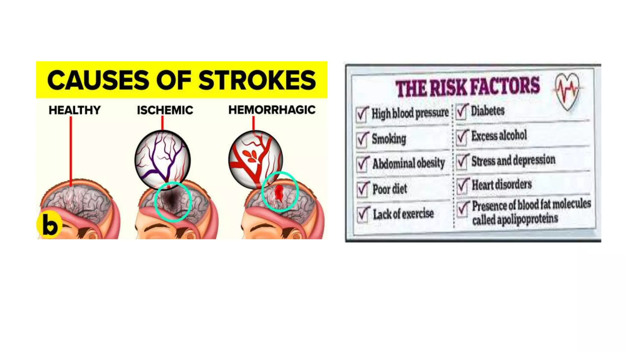 CASE PRESENTATION ON CVA STROKE | PPTX