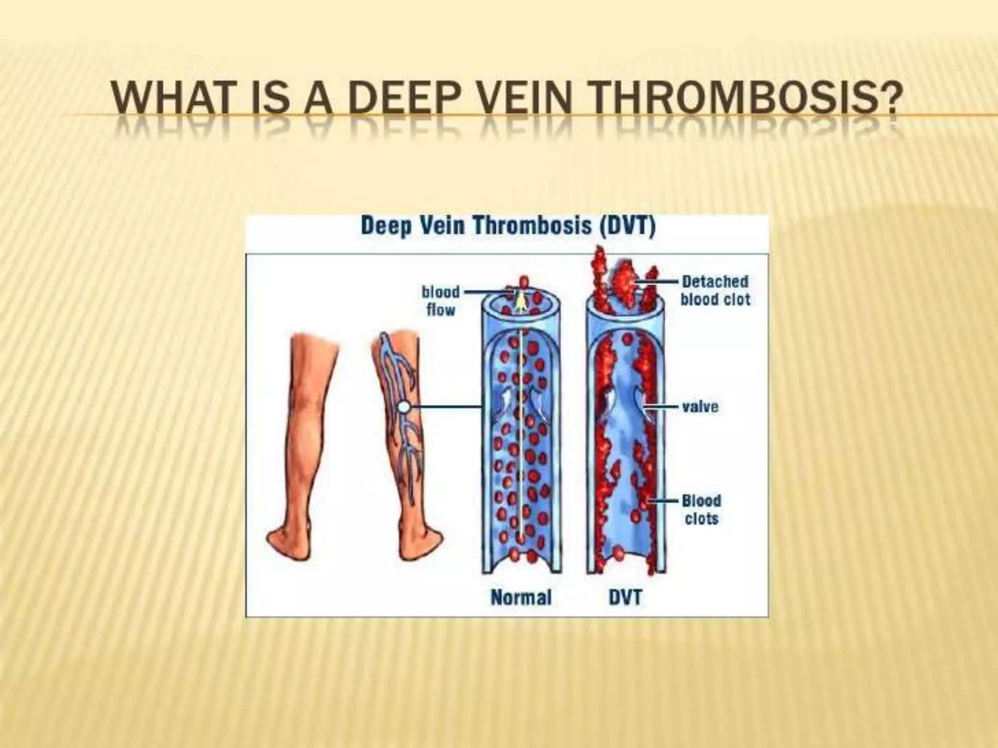 Case presentation on dvt (1) | PPTX