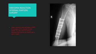 CASE PRESENTATION ON FRACTURE OF HUMERUS.pptx