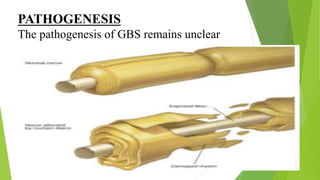 Case presentation on Guillain-Barré syndrom |neuromuscular disorder | PPTX
