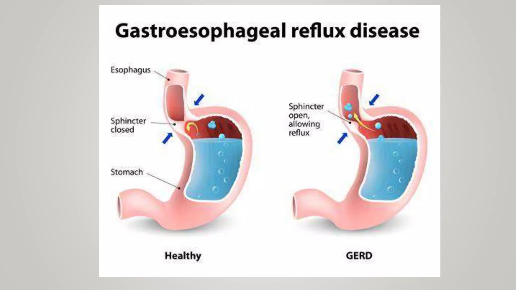 Gastroesophageal reflux disease ( GERD) | PPTX