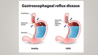Gastroesophageal reflux disease ( GERD) | PPTX