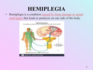 Case presentation on hemiplegia | PPTX