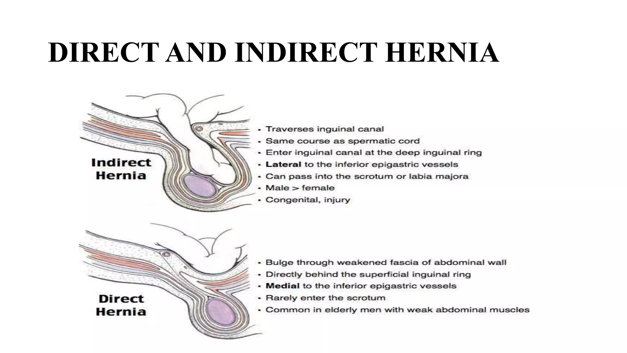 CASE PRESENTATION ON INGUINAL HERNIA | PPTX