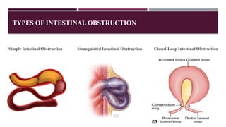 CASE PRESENTATION on Intestinal Obstruction.pptx