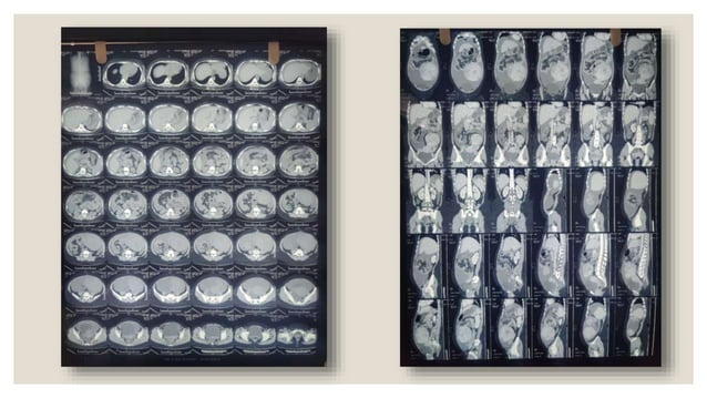 CASE PRESENTATION ON KOCH'S ABDOMEN.pptx | Digestive Disorders ...