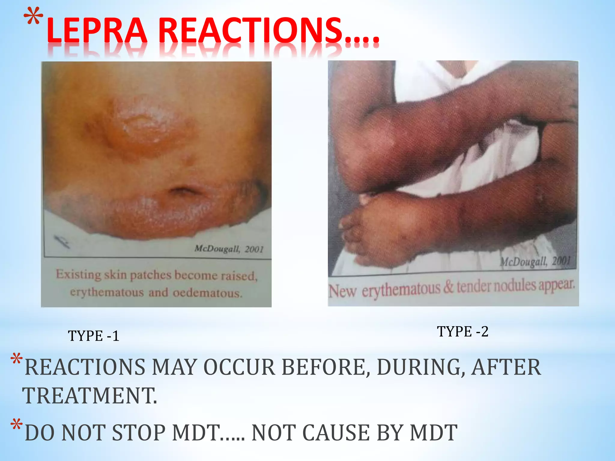 Leprosy: Case Presentation , Facts & Management | PPTX