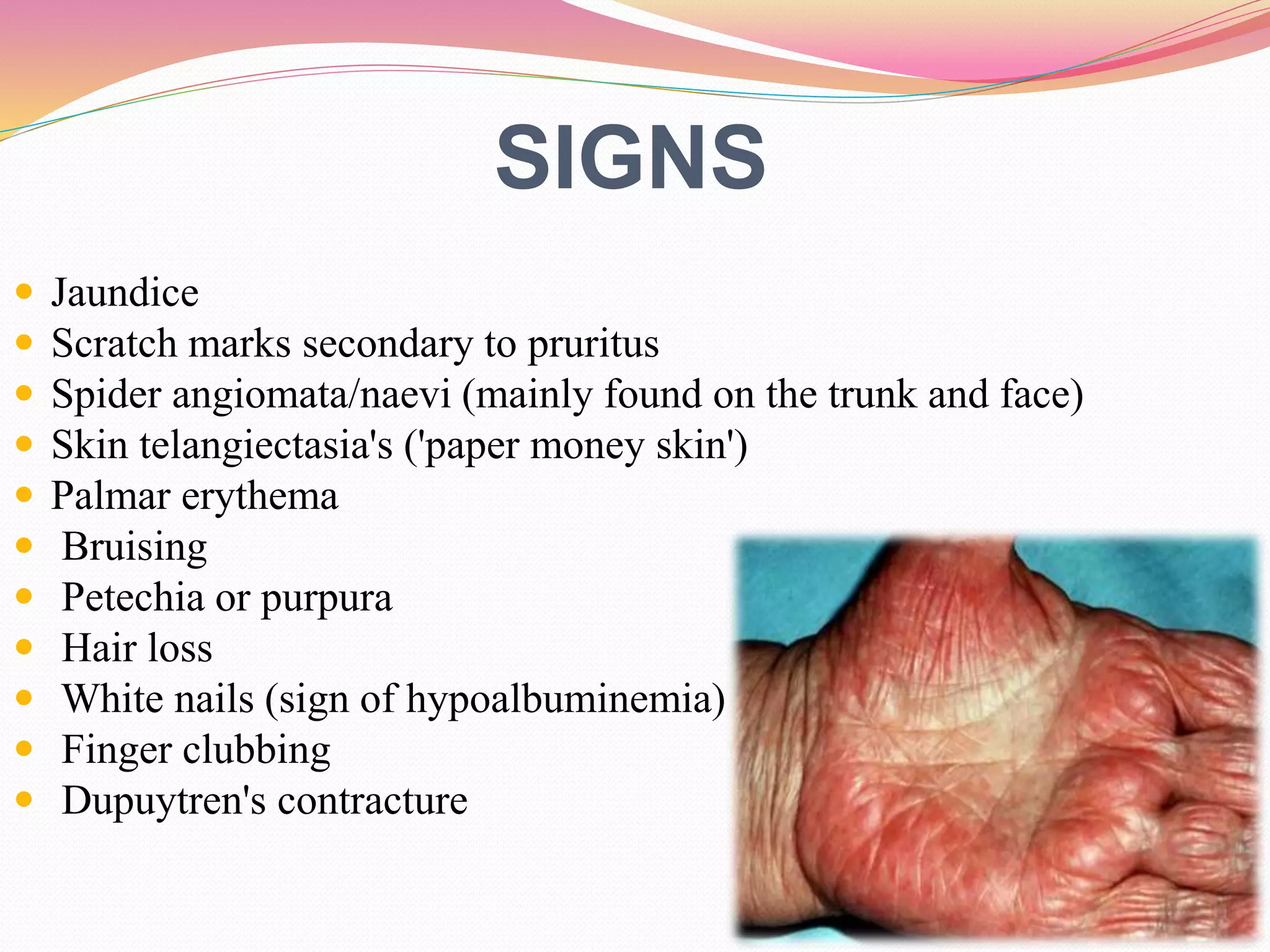CASE PRESENTATION ON CIRRHOSIS OF LIVER WITH PORTAL HYPERTENSION ...