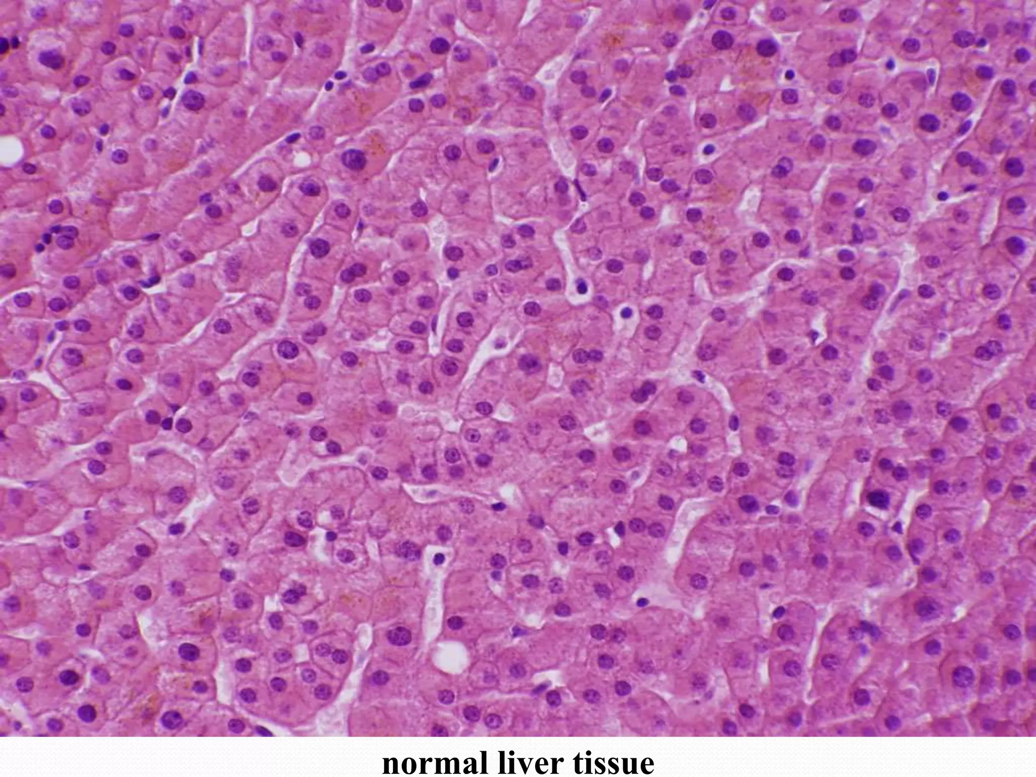 CASE PRESENTATION ON CIRRHOSIS OF LIVER WITH PORTAL HYPERTENSION ...