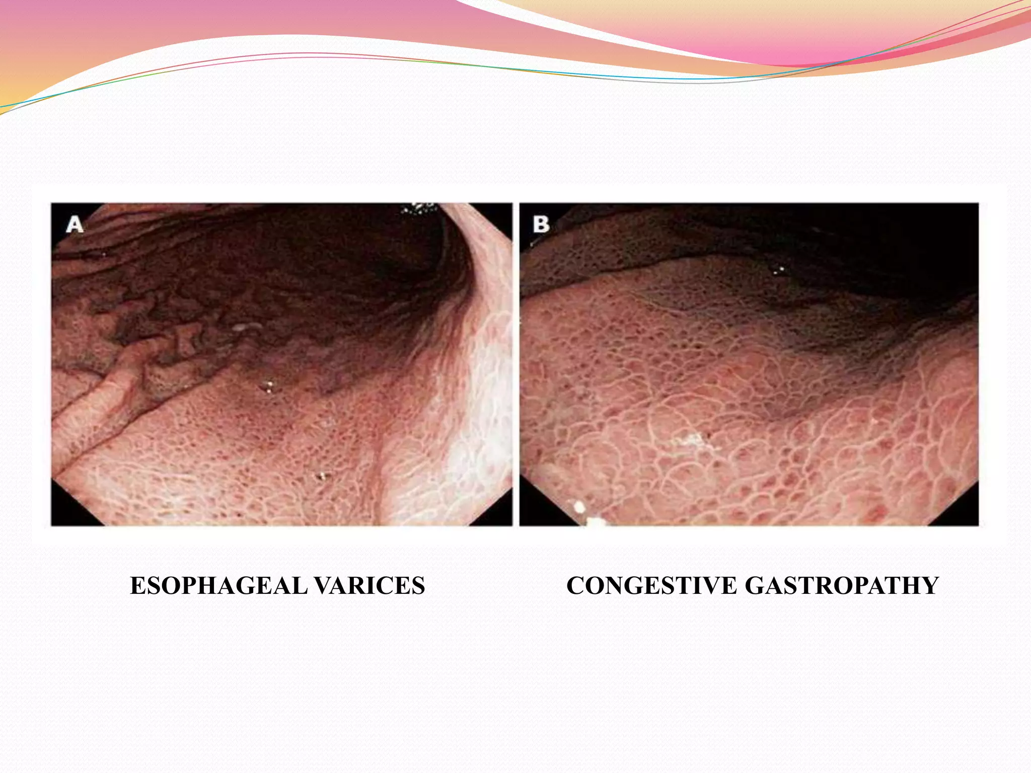 CASE PRESENTATION ON CIRRHOSIS OF LIVER WITH PORTAL HYPERTENSION ...