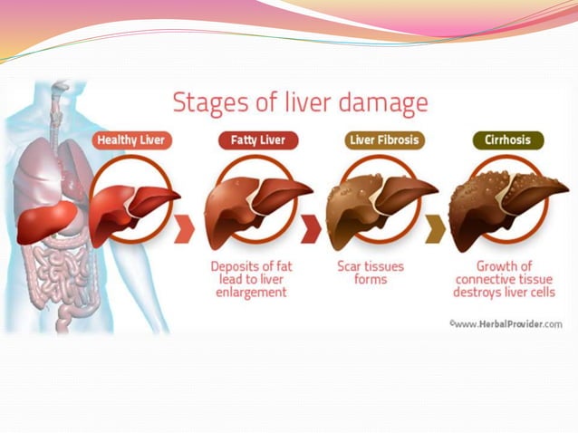 CASE PRESENTATION ON CIRRHOSIS OF LIVER WITH PORTAL HYPERTENSION ...