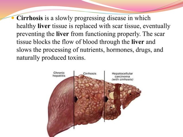 CASE PRESENTATION ON CIRRHOSIS OF LIVER WITH PORTAL HYPERTENSION ...